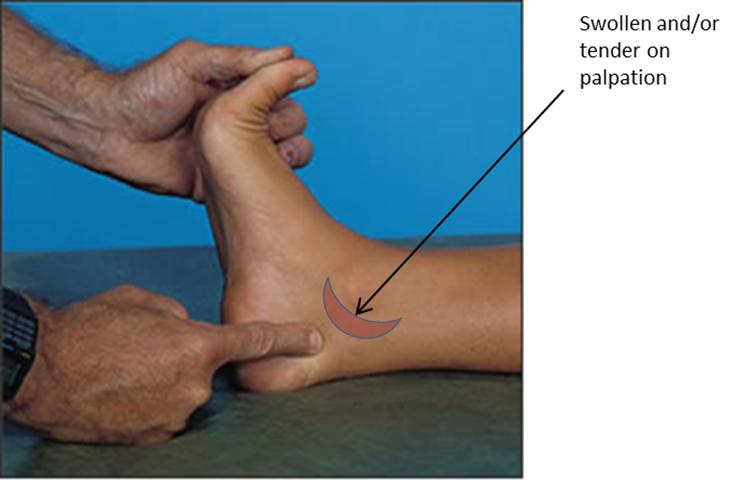 Medial Ankle Pain/ Tibialis Posterior Dysfunction (TPD) pathway ...